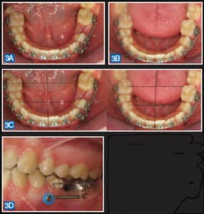 Miniscrews | Orthodontic Products