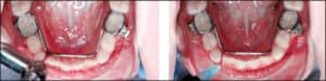 The Mandibular E-arch | Orthodontic Products