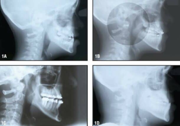 Managing the Growing, Class III Patient | Orthodontic Products
