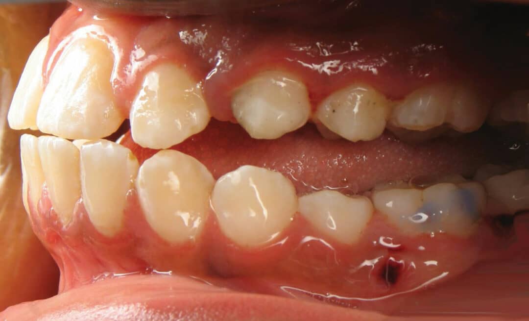 Mechanotherapy and Open Bite Malocclusions | Orthodontic Products