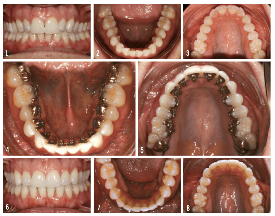 Lingual for Everyone | Orthodontic Products