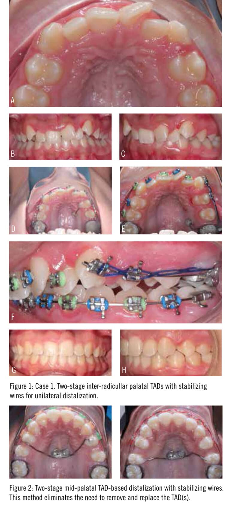 Maxillary Distalization with TADs | Orthodontic Products