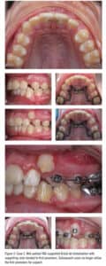 Maxillary Distalization with TADs | Orthodontic Products