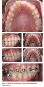 Maxillary Distalization with TADs | Orthodontic Products