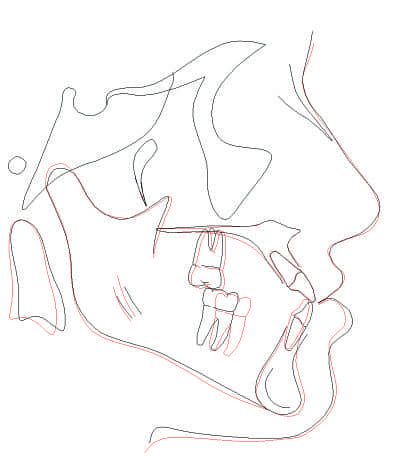 Class III Camouflage with Mandibular Bicuspid Extraction | Orthodontic ...
