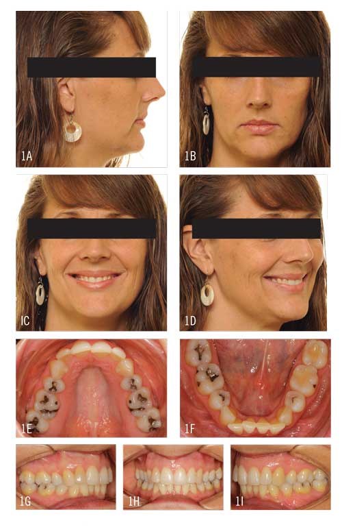 Recapturing Youth with TADs | Orthodontic Products