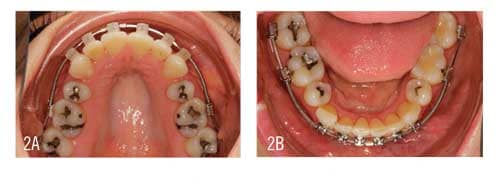 Recapturing Youth with TADs | Orthodontic Products