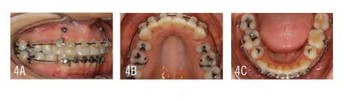 Recapturing Youth with TADs | Orthodontic Products