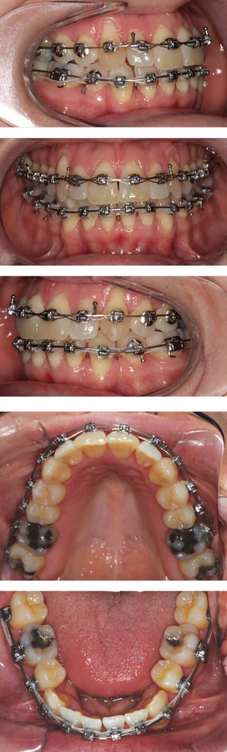 A Case for Extractions | Orthodontic Products