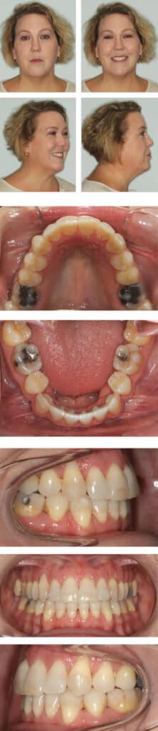 A Case for Extractions | Orthodontic Products