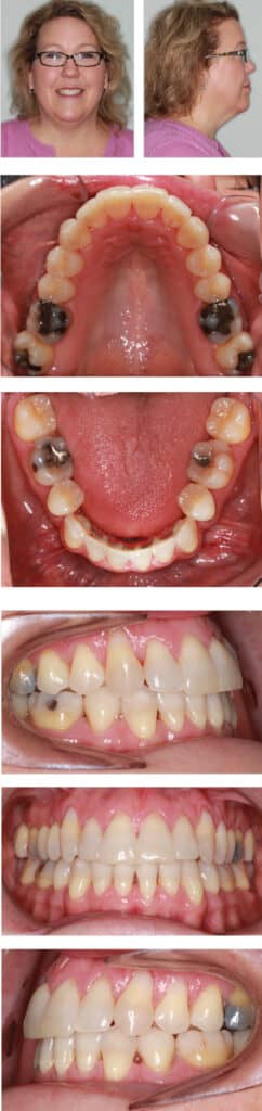 A Case for Extractions | Orthodontic Products