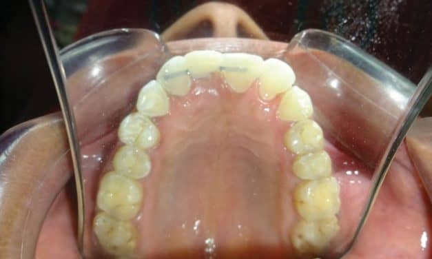 Clinical Pearl: Temporary Phantom Tooth | Orthodontic Products