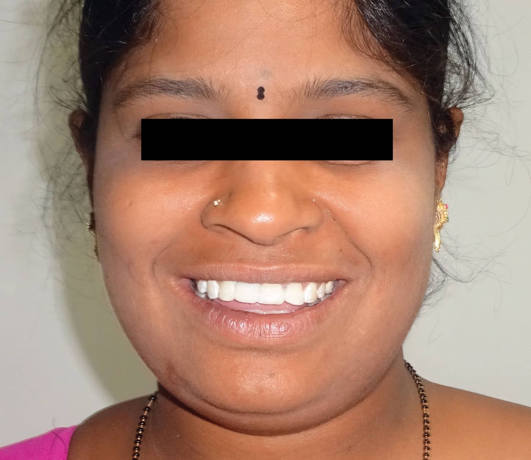 Clinical Pearl: Temporary Phantom Tooth | Orthodontic Products