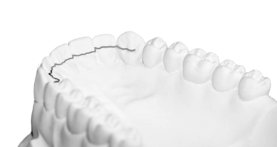 Innovation Comes to Retention | Orthodontic Products