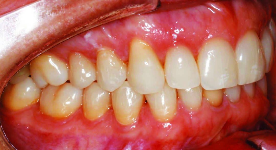 Finding the Right Aligner Brand for Your Practice | Orthodontic Products