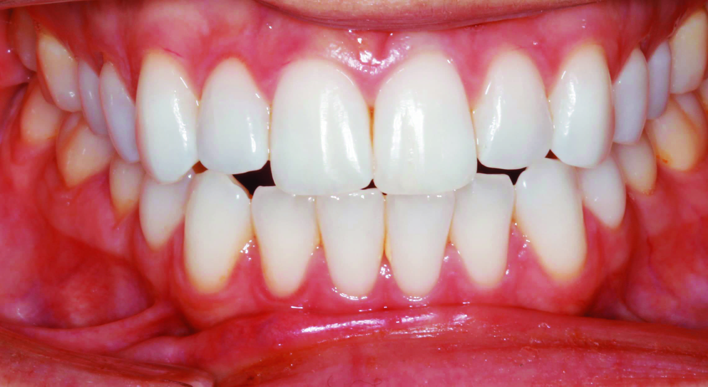 Finding the Right Aligner Brand for Your Practice | Orthodontic Products