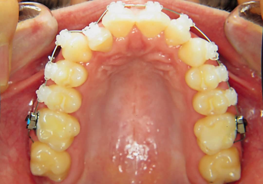 Five Factors of Ceramic Brackets | Orthodontic Products