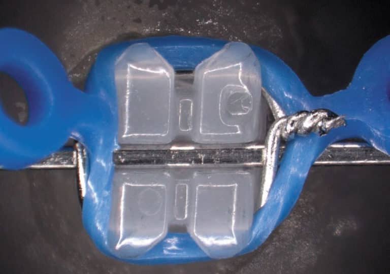 Five Factors of Ceramic Brackets | Orthodontic Products