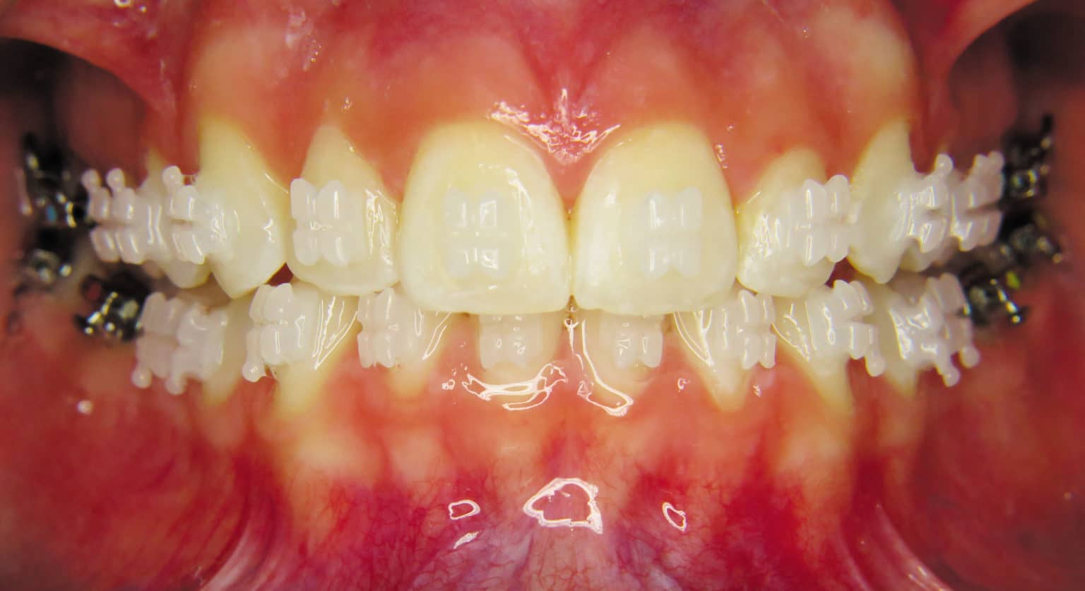 Five Factors of Ceramic Brackets | Orthodontic Products