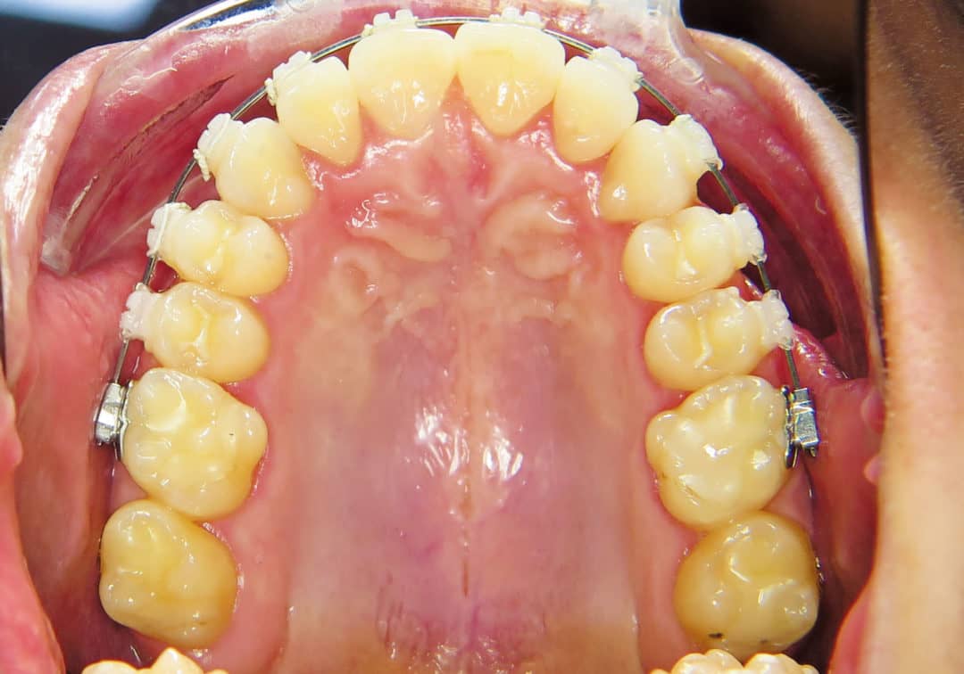 Five Factors of Ceramic Brackets | Orthodontic Products