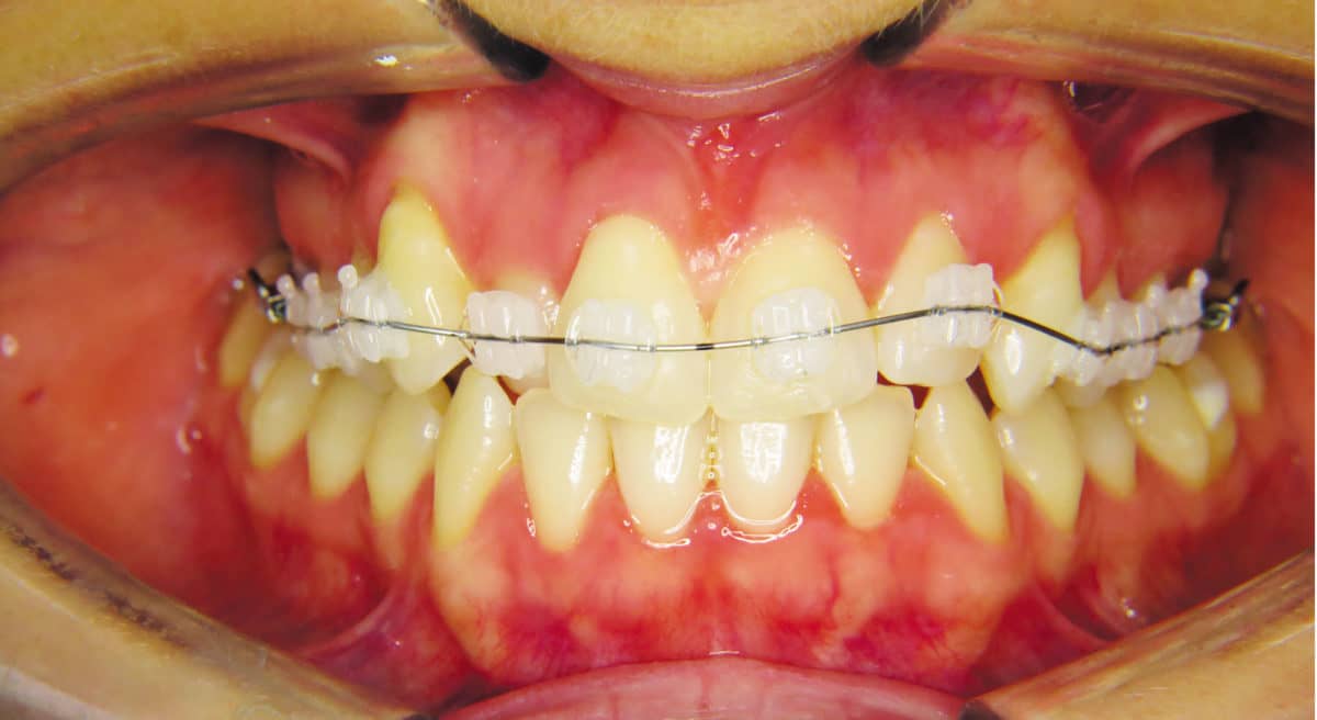 Five Factors of Ceramic Brackets | Orthodontic Products