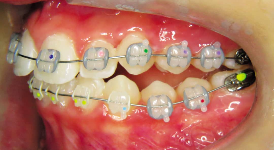 Five Factors of Ceramic Brackets | Orthodontic Products