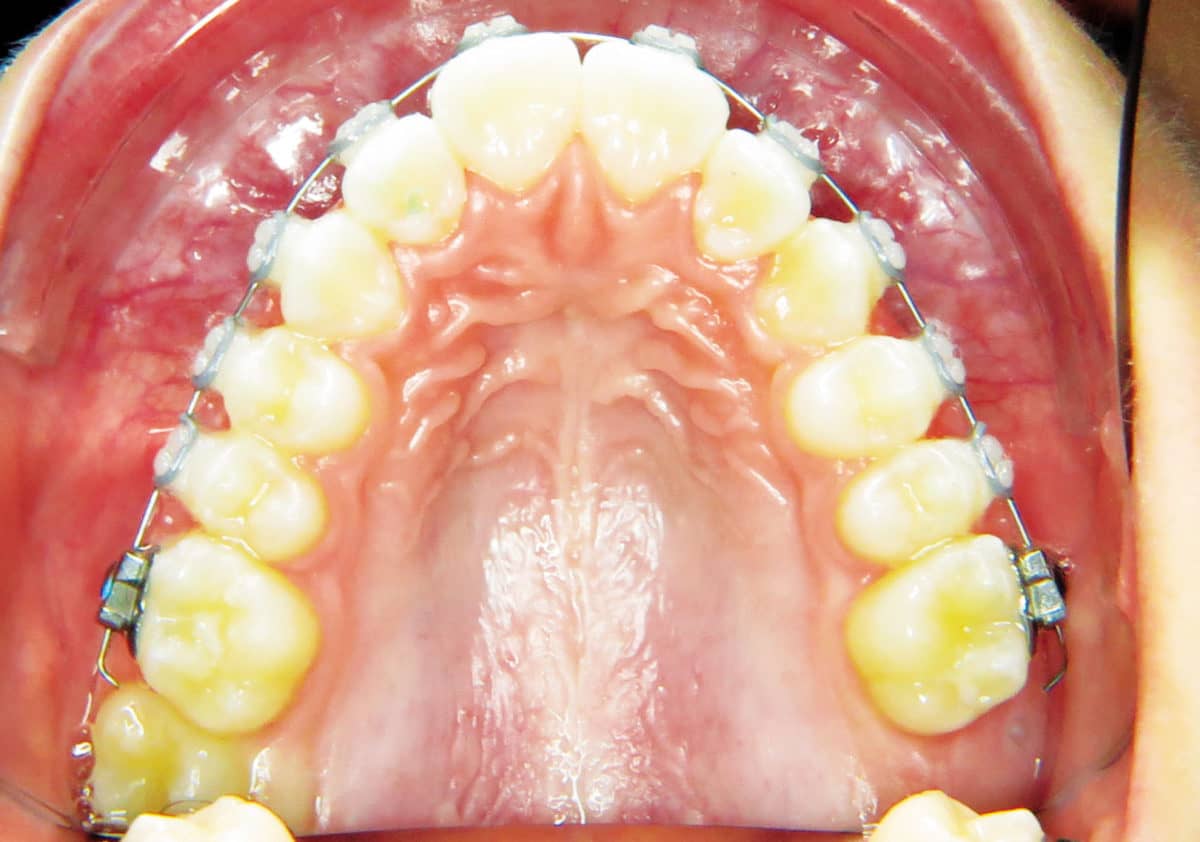 Five Factors of Ceramic Brackets | Orthodontic Products