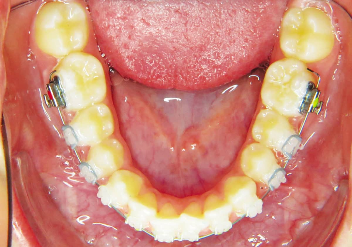 Five Factors of Ceramic Brackets | Orthodontic Products