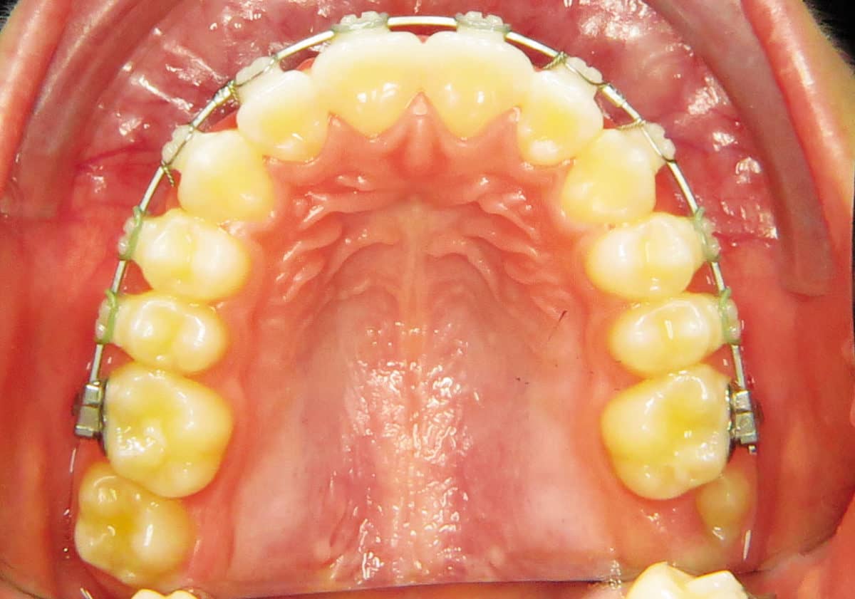 Five Factors of Ceramic Brackets | Orthodontic Products