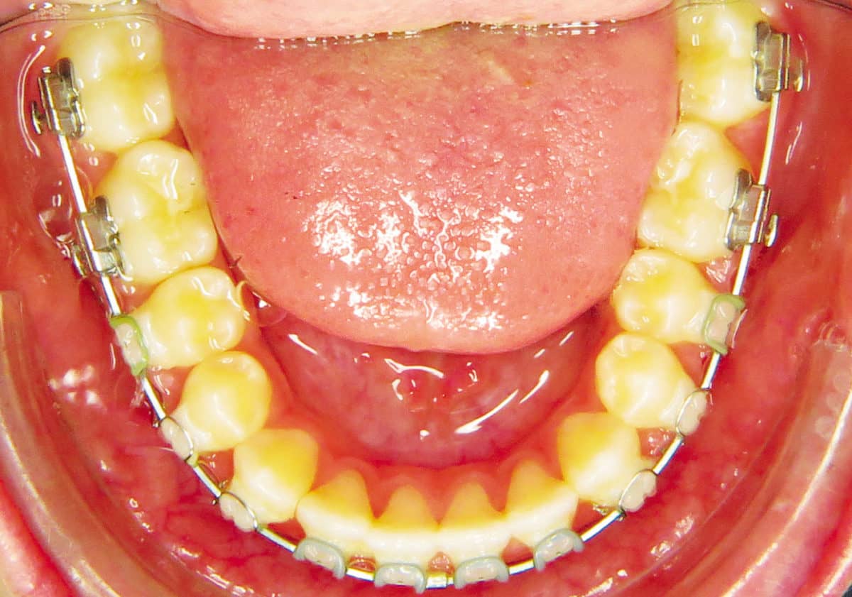 Five Factors of Ceramic Brackets | Orthodontic Products