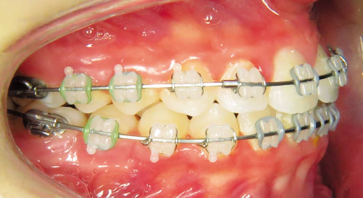 Five Factors of Ceramic Brackets | Orthodontic Products