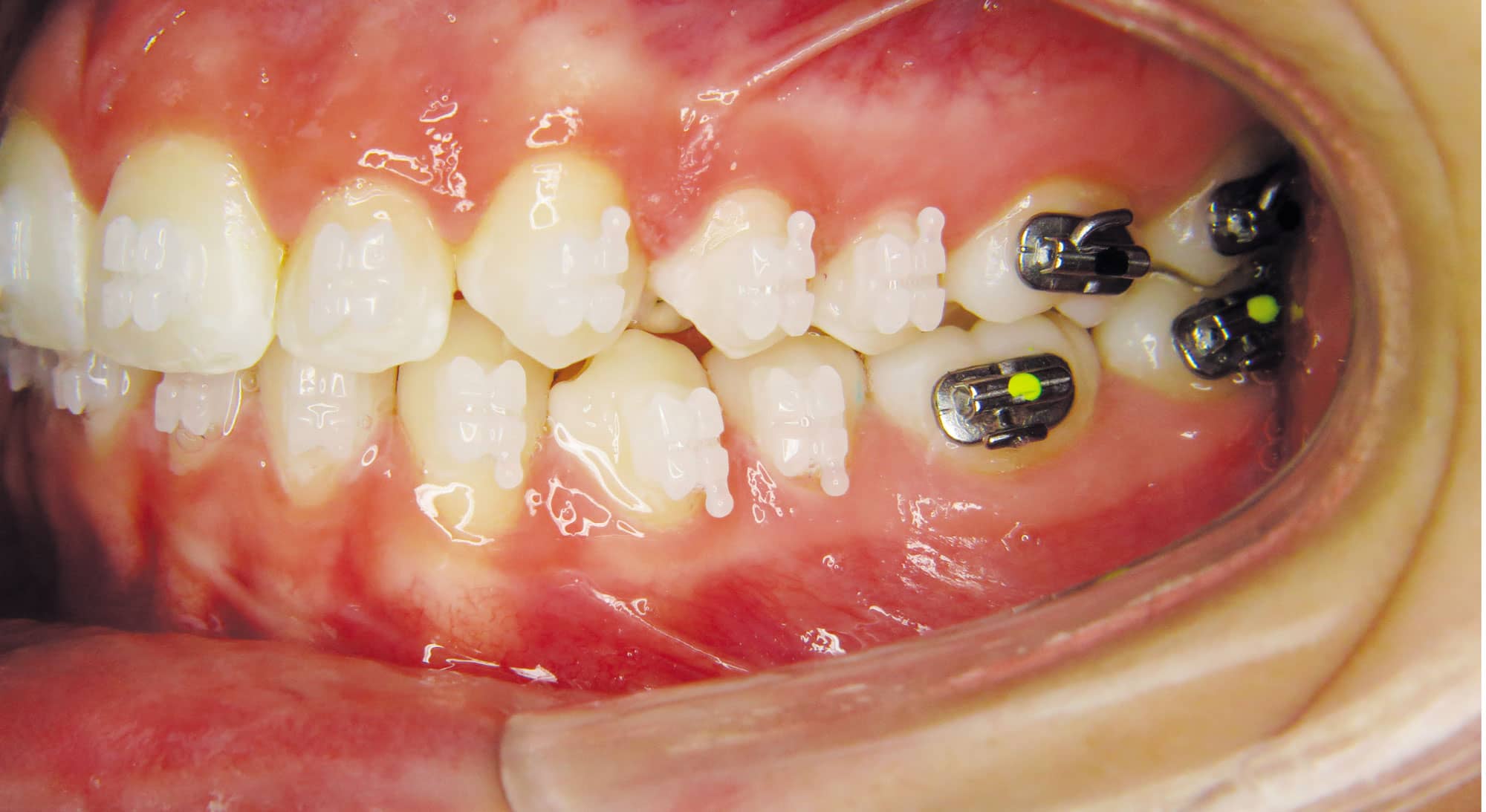 Five Factors of Ceramic Brackets | Orthodontic Products