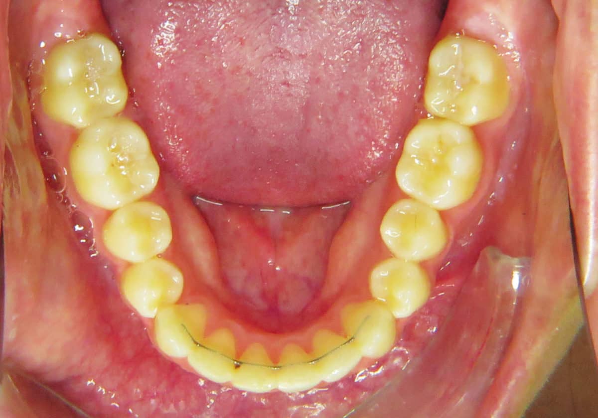 Five Factors of Ceramic Brackets | Orthodontic Products