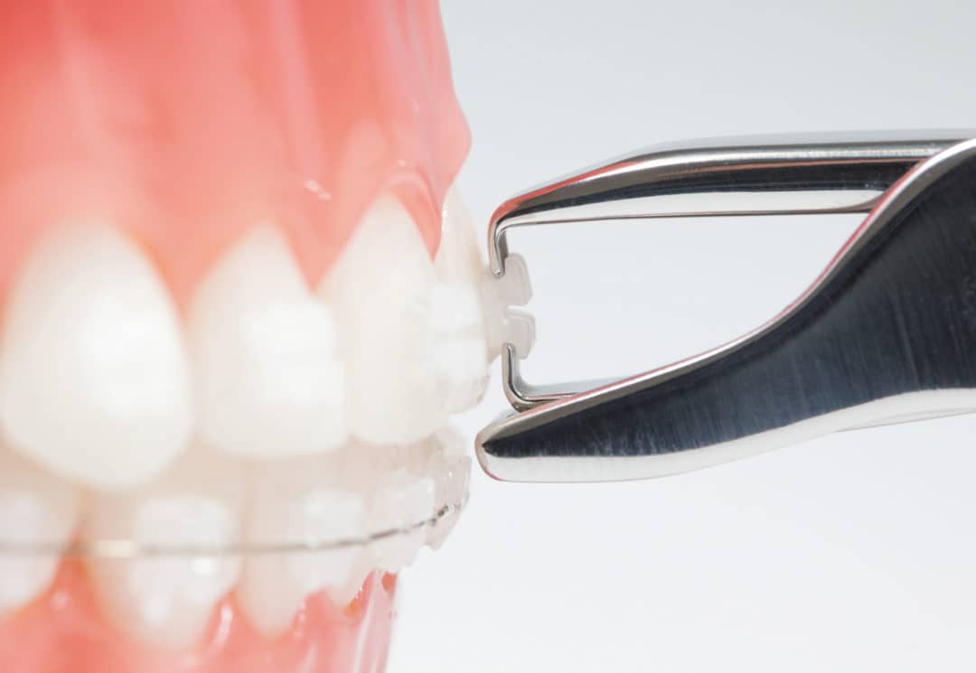 Five Factors of Ceramic Brackets | Orthodontic Products