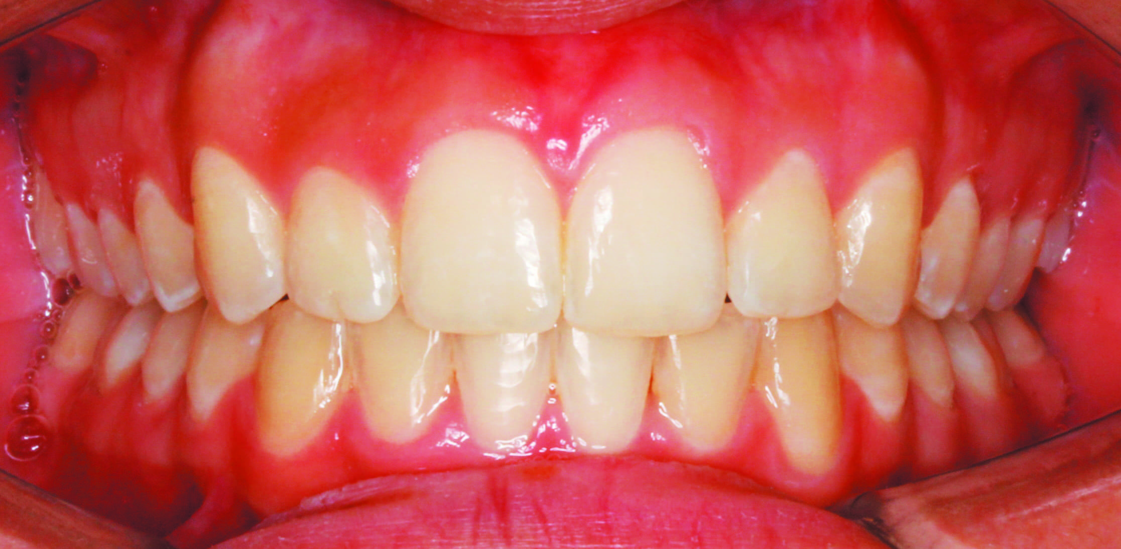 The Efficiencies of Soft Tissue Lasers | Orthodontic Products