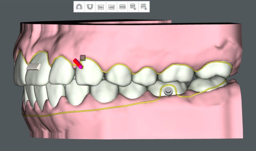 Software Pro Tip: SureSmile Digital Lab | Orthodontic Products