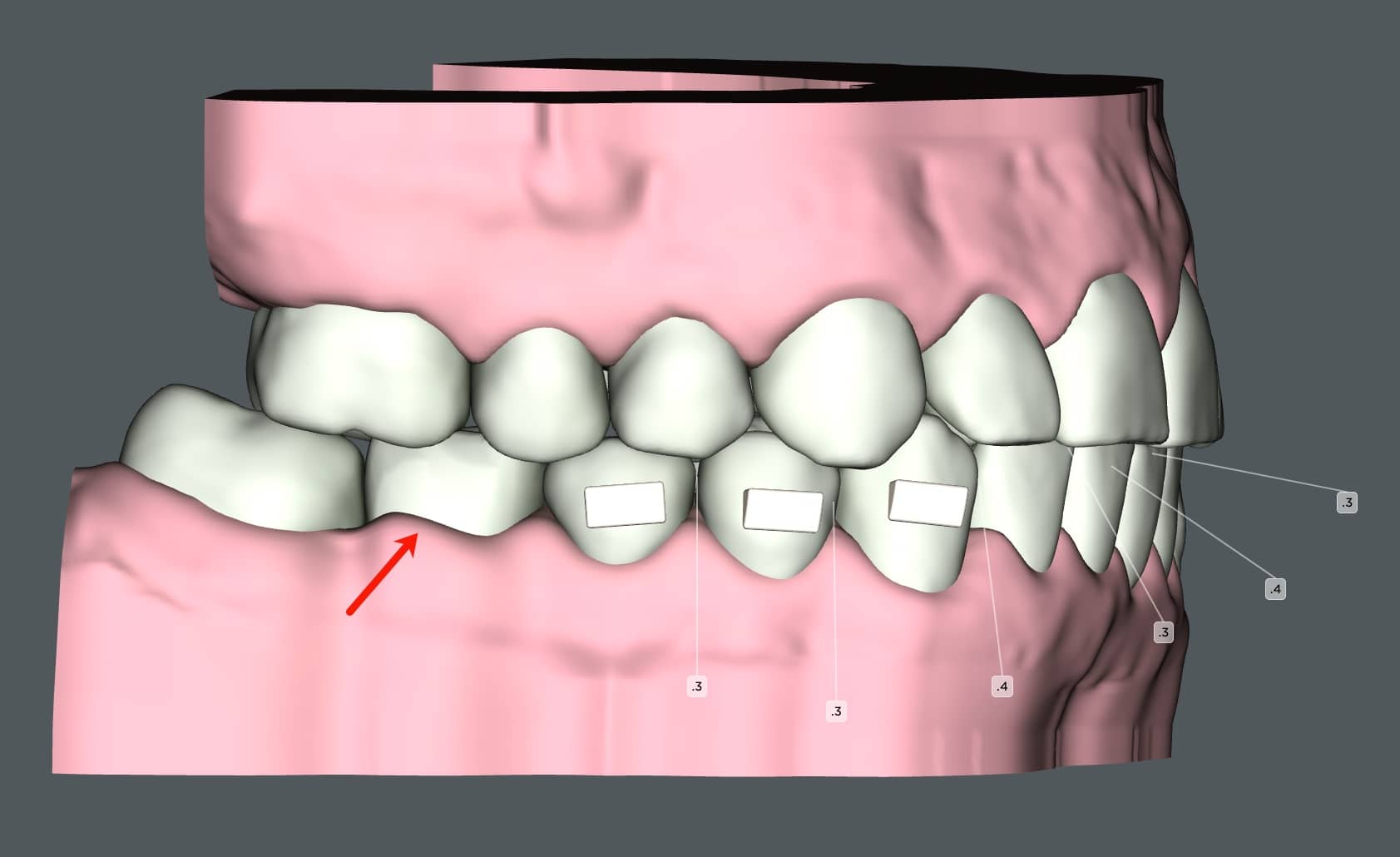 Software Pro Tip: SureSmile Digital Lab | Orthodontic Products