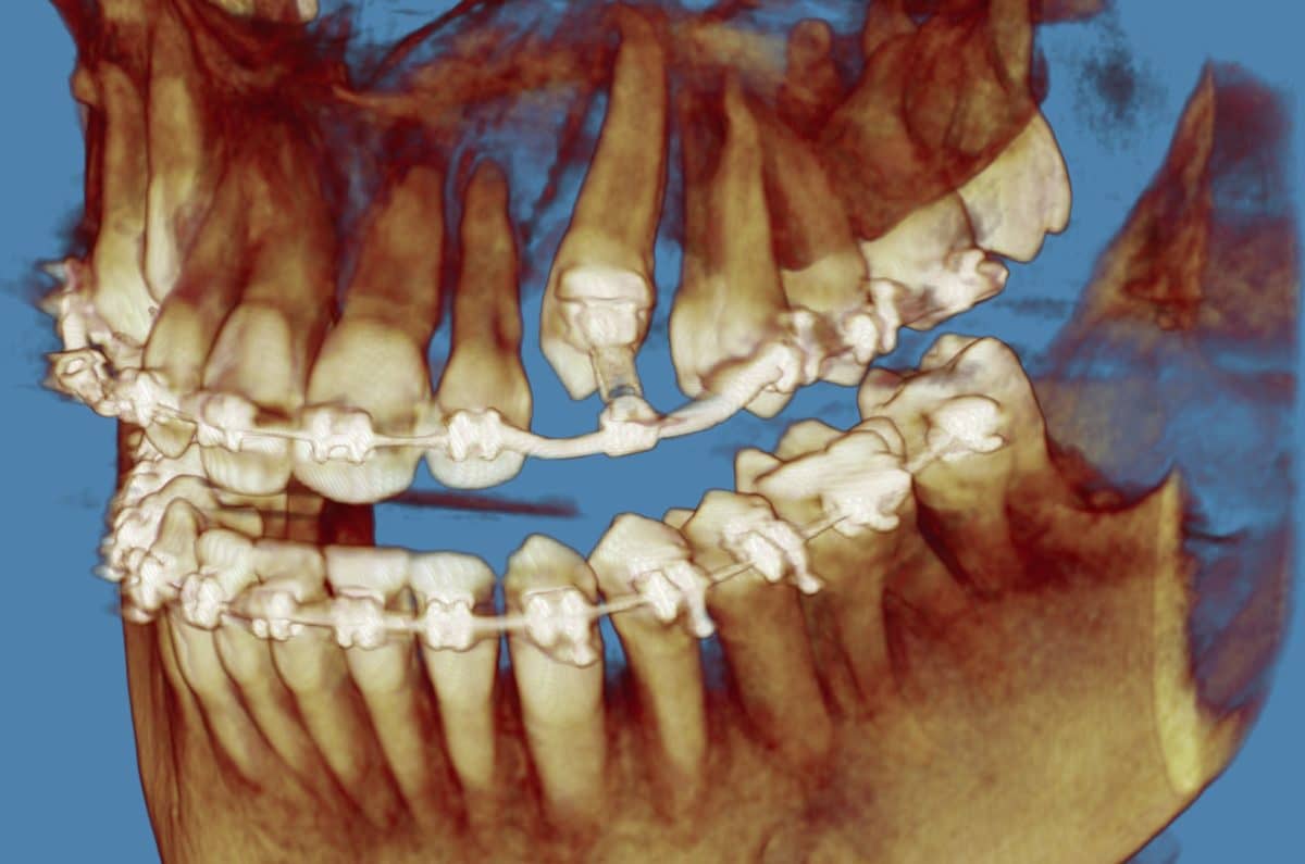 Impacted Canine Treatment Springs Forward | Orthodontic Products