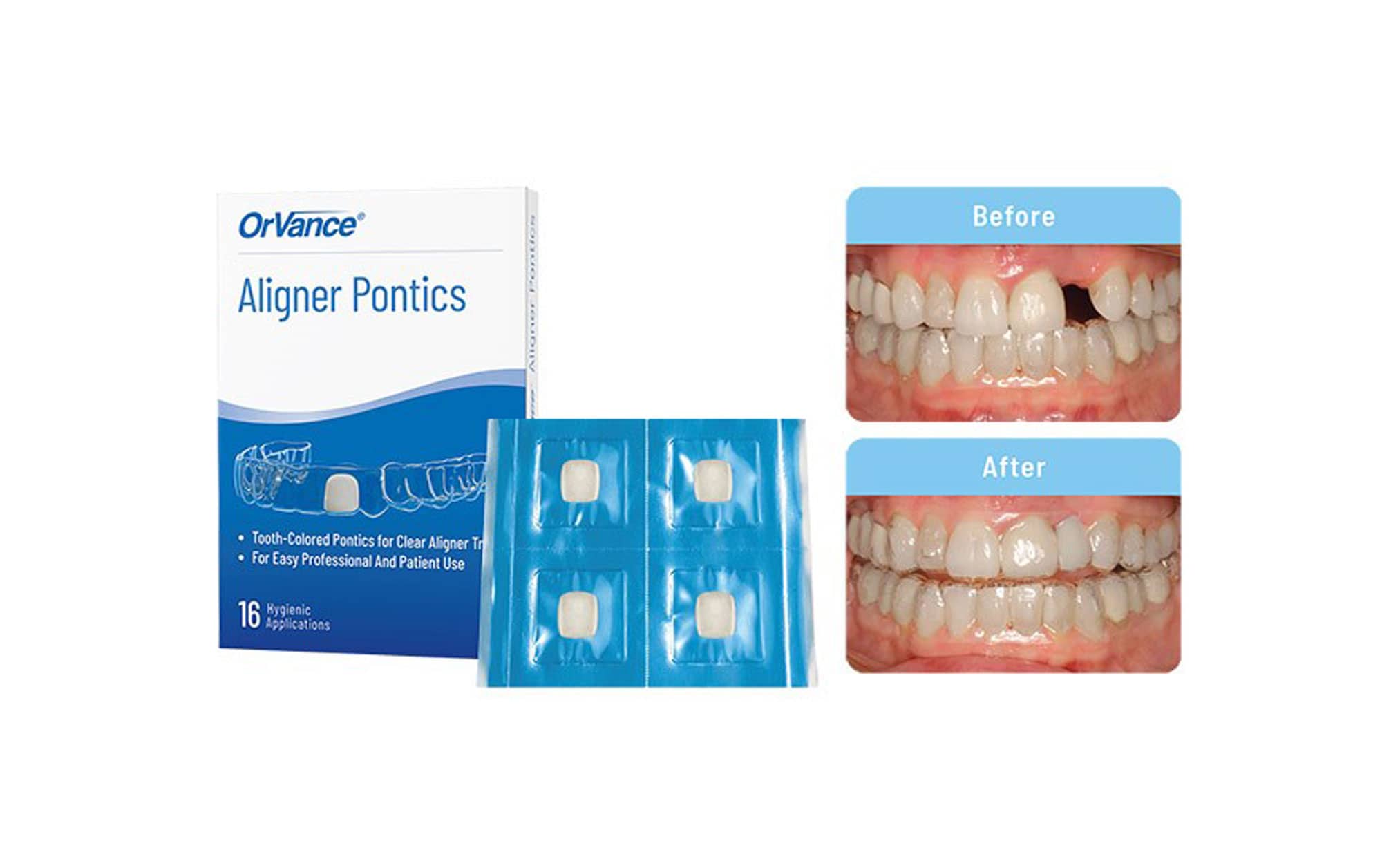 OrVance Launches Aligner Pontic Solution for Patient Use | Orthodontic ...