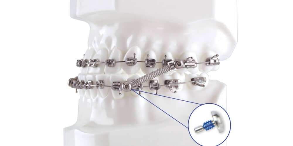 DynaFlex Introduces CS5 System with Nylok Coated Screw | Orthodontic ...