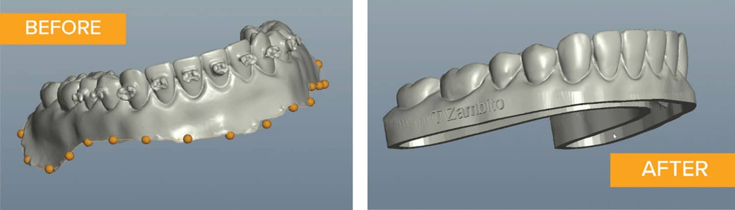 EasyRX Adds 3D Automated Bracket Removal | Orthodontic Products