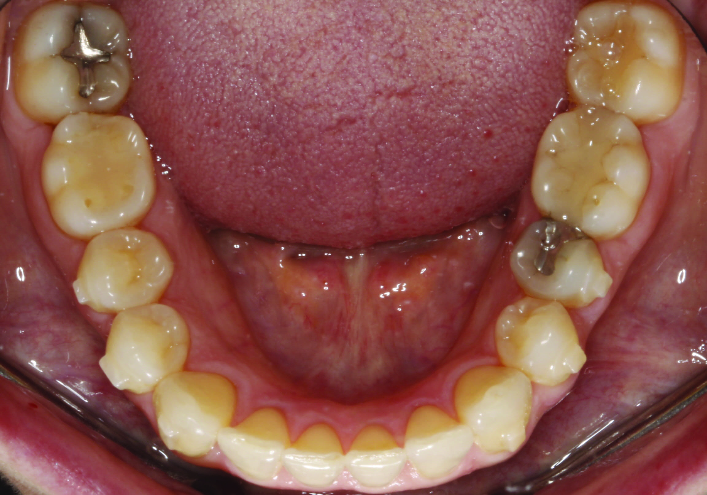 Clinical Products Spotlight: A Deep Dive into the Spark Clear Aligner ...