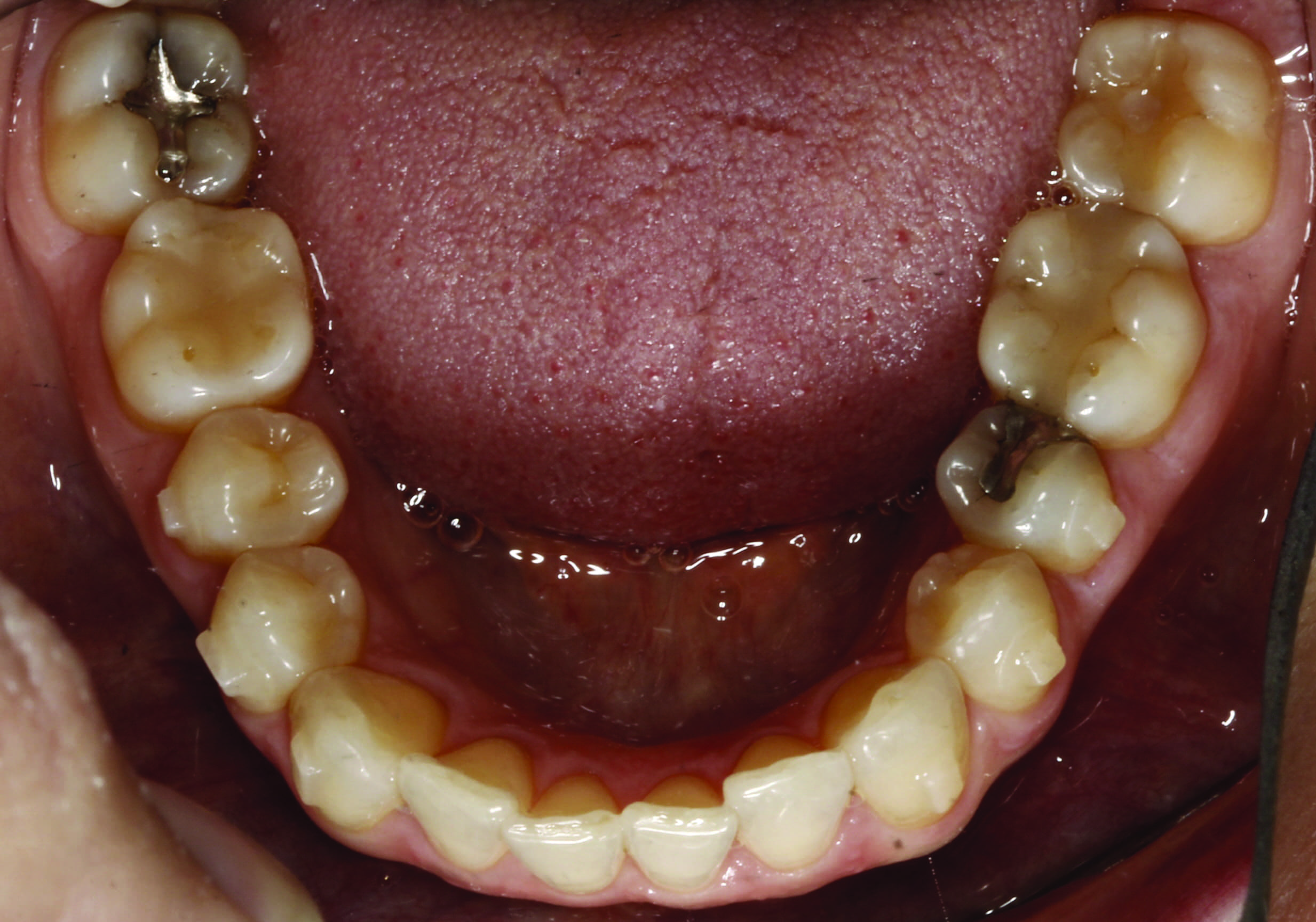 Clinical Products Spotlight: A Deep Dive into the Spark Clear Aligner ...