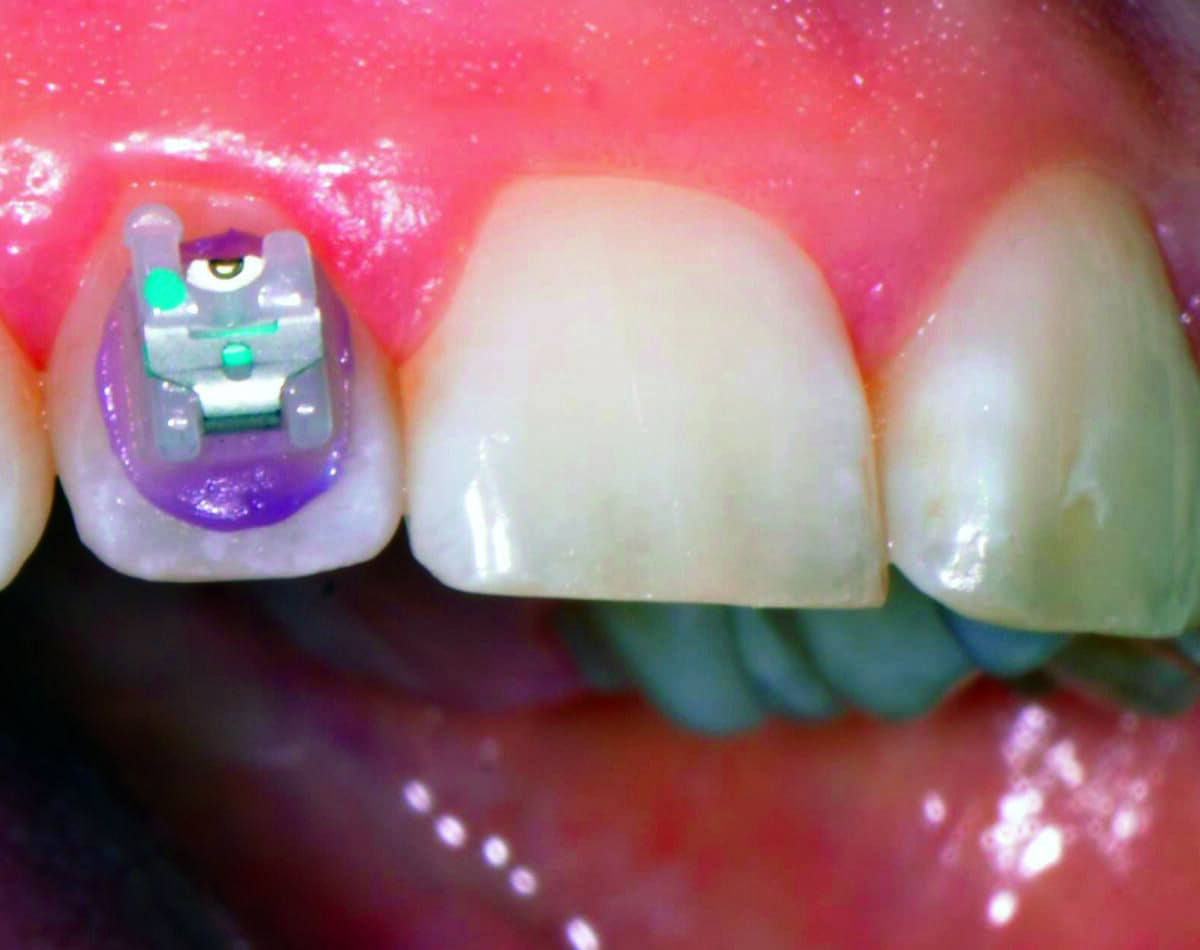 Clinical Products Spotlight: Building Up the BracePaste Line ...