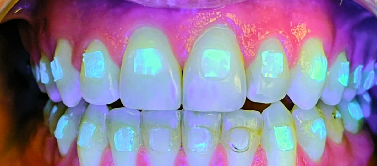 Clinical Products Spotlight: Building Up the BracePaste Line ...