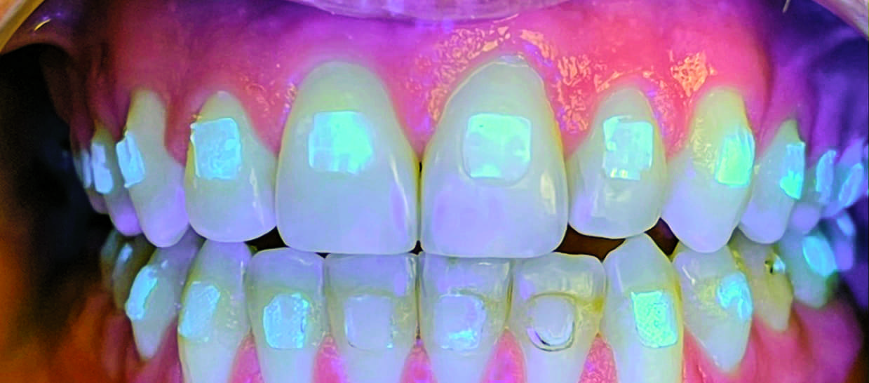 Clinical Products Spotlight: Building Up the BracePaste Line ...