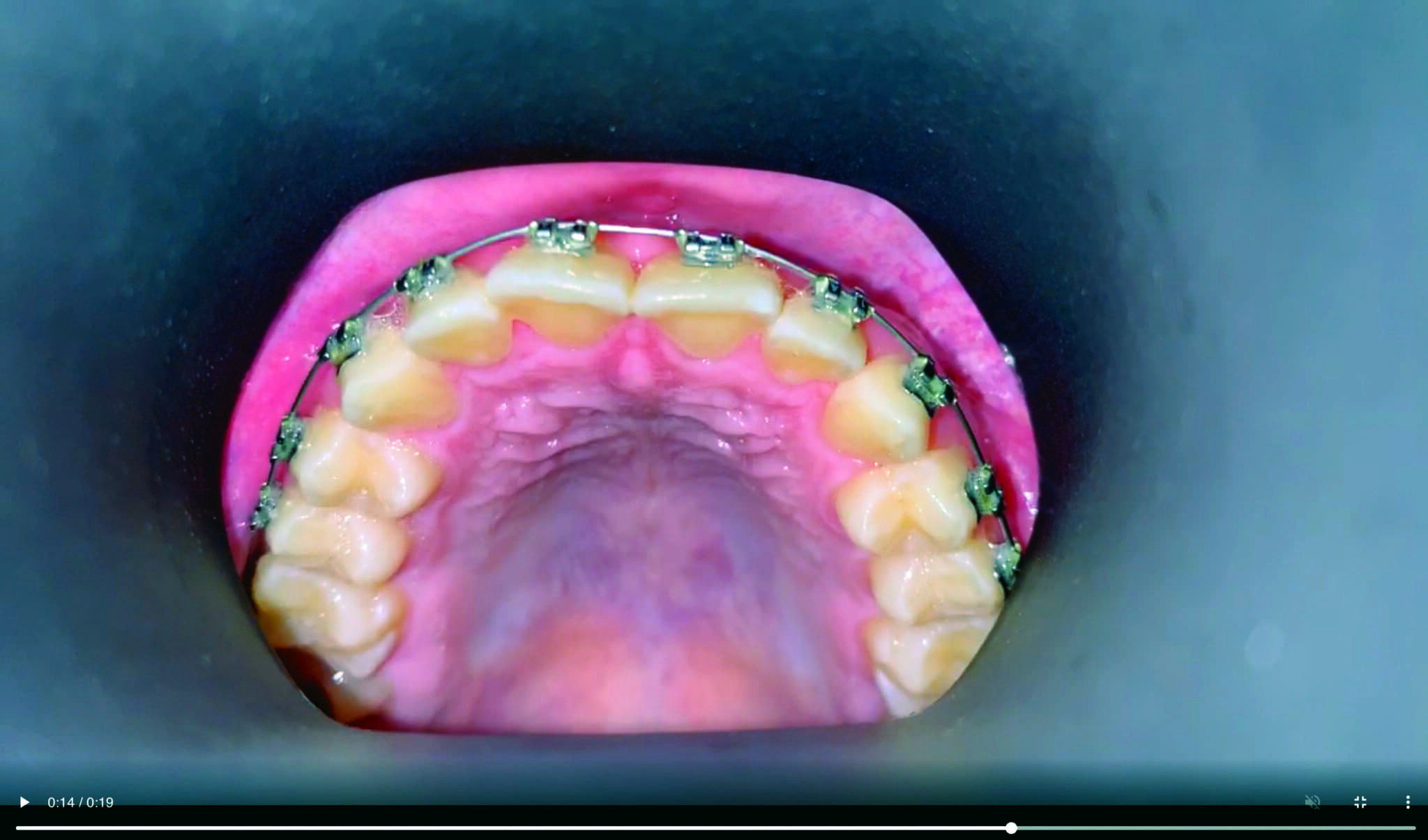 Confluence of Technologies: A Custom Bracket System and Teledentistry ...