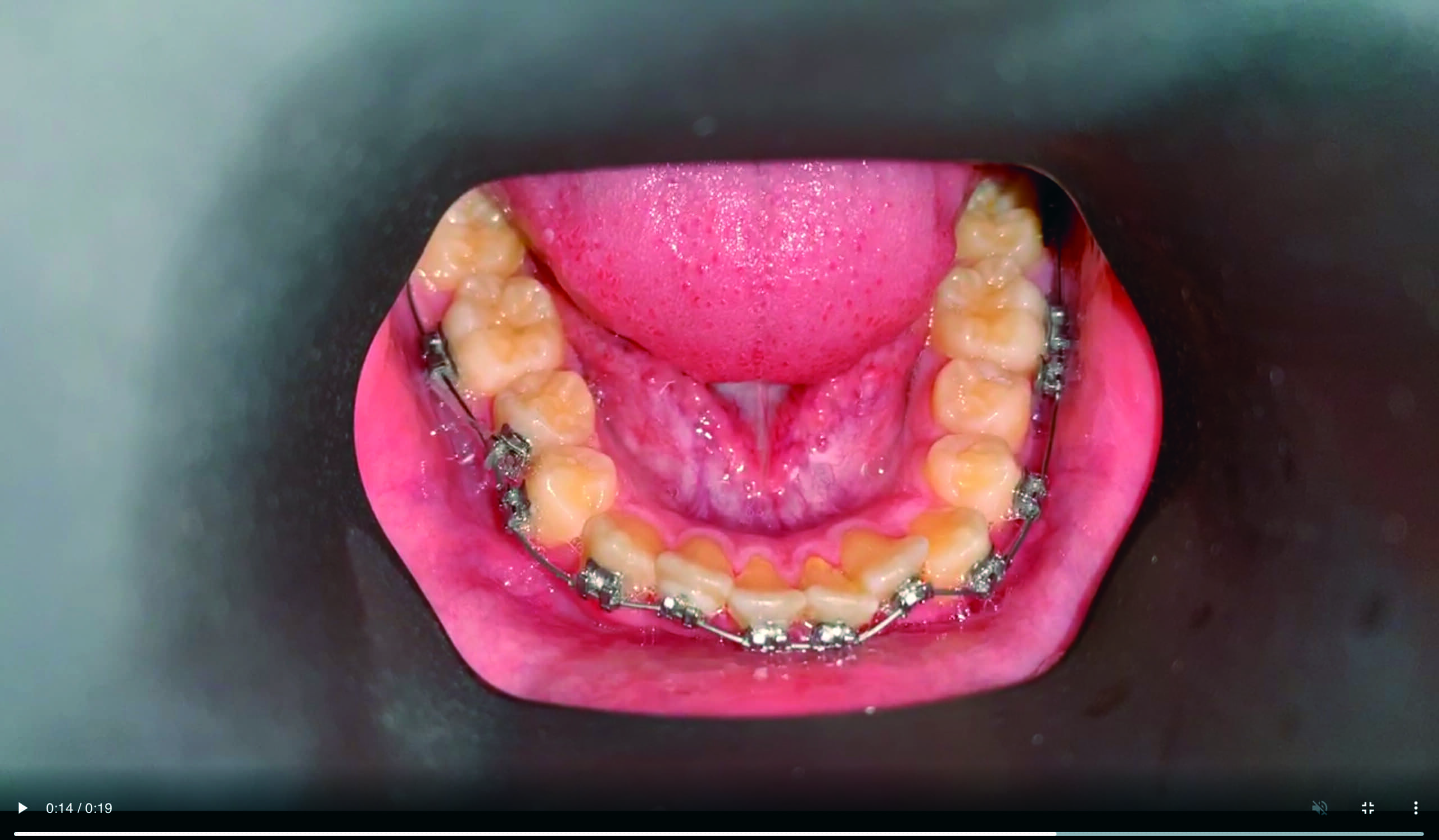 Confluence of Technologies: A Custom Bracket System and Teledentistry ...