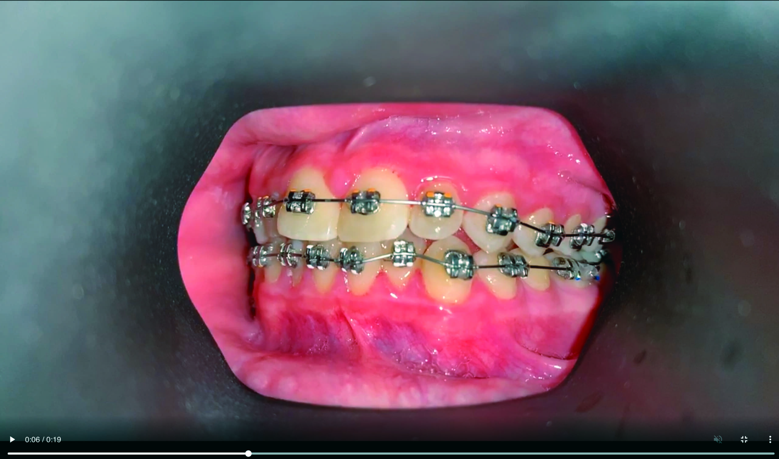 Confluence of Technologies: A Custom Bracket System and Teledentistry ...