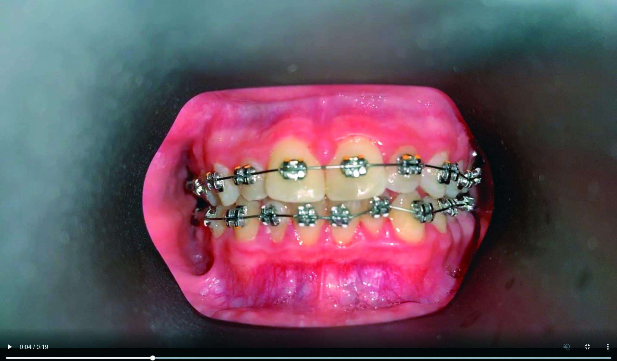 Confluence of Technologies: A Custom Bracket System and Teledentistry ...